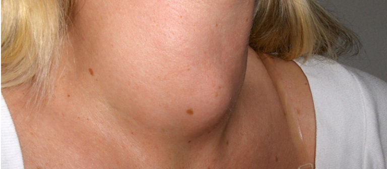 bocio-multinodular - Blog de tiroides | Dr. Óscar Vidal Blog de ...