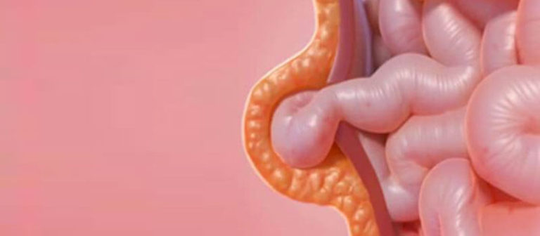 Peri Umbilical Hernia